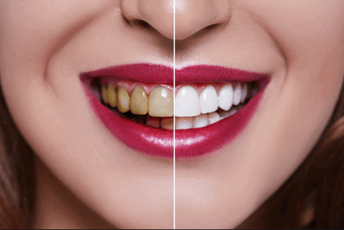The Different Types of Teeth Whitening Treatment You Need To Know