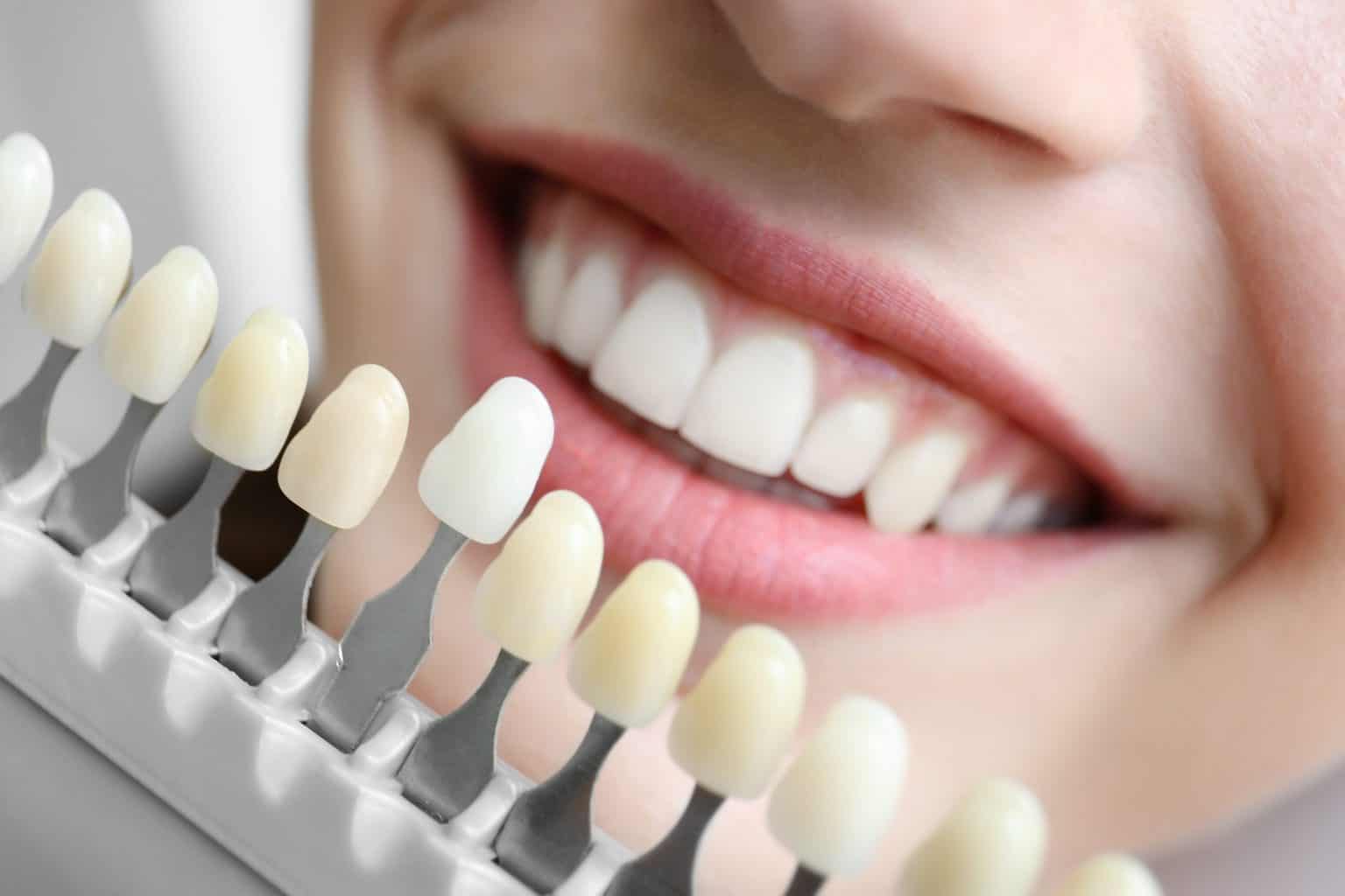 The Best Toothpaste For Porcelain Veneers - Parkdale Family Dental