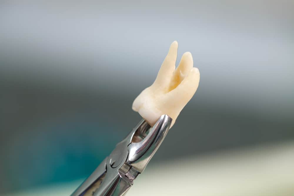 How Does Tooth Extraction Work